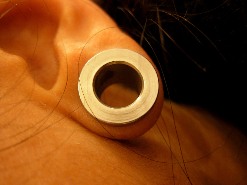 Chirurgie lobe d'oreille fendu - Dermatologue Dr Cante - Bordeaux