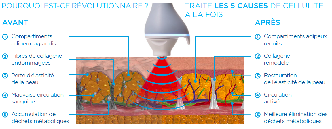 Traitement anti-cellulite Emtone® à Bordeaux : questions réponses