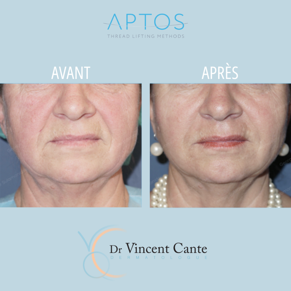 Les fils tenseurs résorbables APTOS - Dr Vincent Cante - Dermatologue Bordeaux
