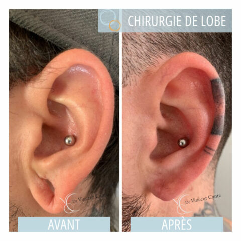 Chirurgie lobe d'oreille fendu - Dermatologue Dr Cante - Bordeaux