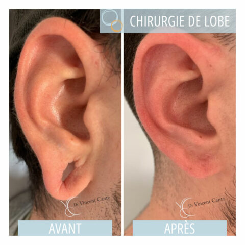 Chirurgie lobe d'oreille fendu - Dermatologue Dr Cante - Bordeaux
