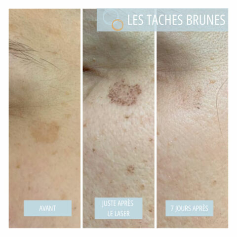 Traitement des tâches brunes pigmentaires - Dr Cante - Bordeaux
