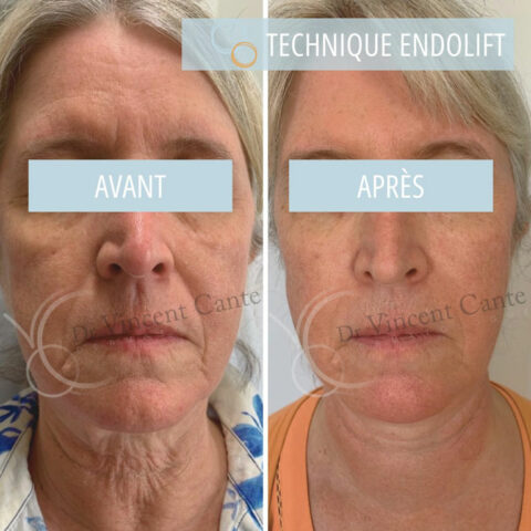 La technique Endolift® du lifting laser est disponible à Bordeaux